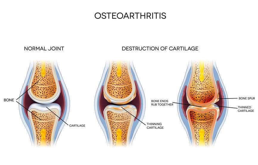 Try These Foods Good For Joints And Cartilage (And Avoid These Others ...